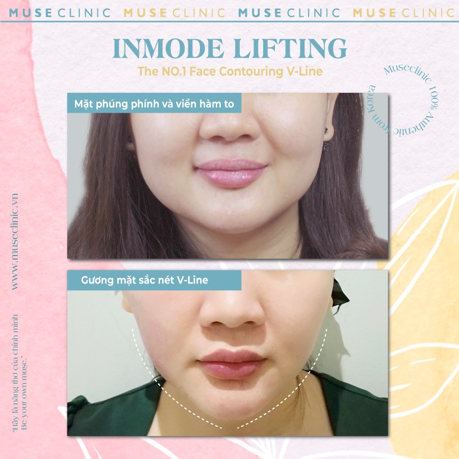 Công Nghệ InMode Lifting - Giải pháp tạo hình V-Line và thon gọn gương mặt tại TMV Muse Clinic